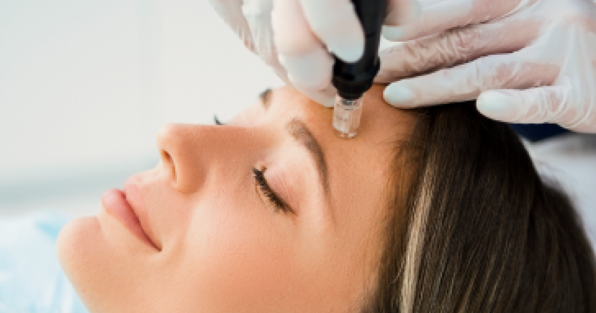 RF Skin Needling | Aesthetica Cosmetic Clinic
